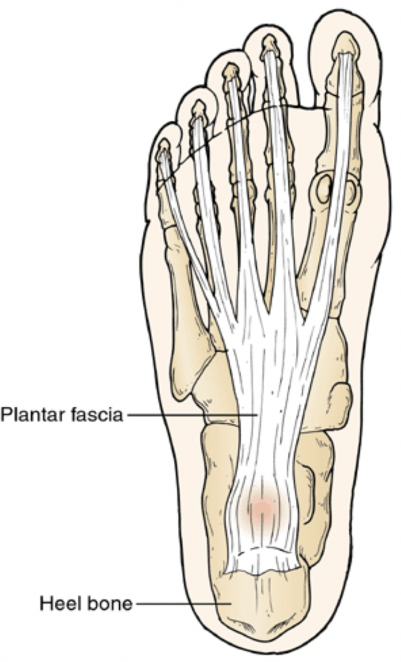 Plantar Fasciitis - Western Montana Foot & Ankle